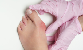 Kada "moda" zaboli: Zašto nastaju čukljevi? | Lepotica.rs